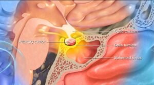 Pituitary tumors and neuroendocrine disorders - Dr. Patil's Diabetes ...
